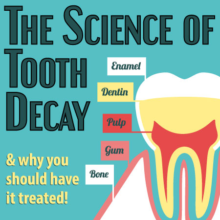 The Science of Tooth Decay in North Reading, MA | Inertia Dental